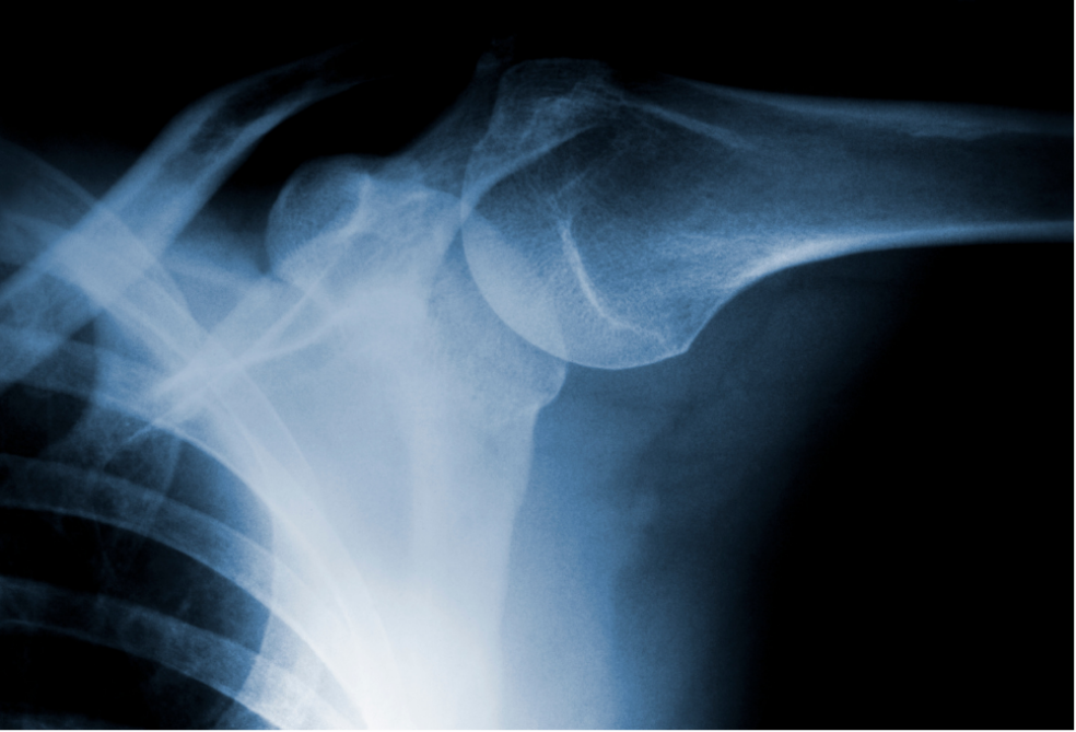 Zakaj nastane kalcinacija sklepov in kako jo zdravimo? - Abczdravja